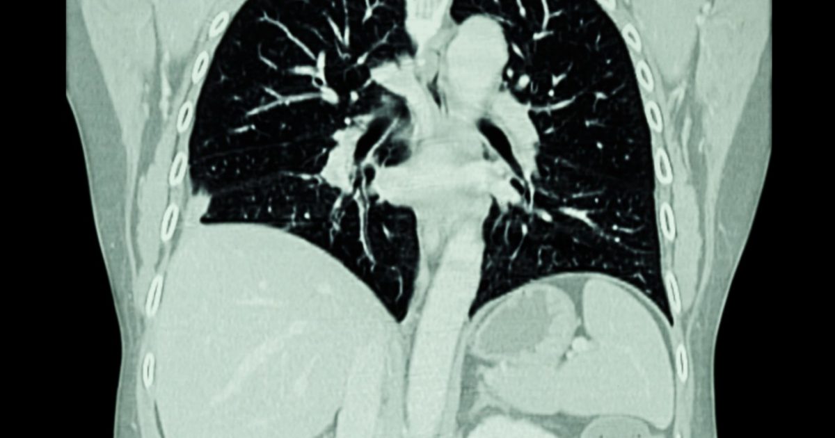 COPD Patients With Bronchiectasis Show Worsening Clinical Symptoms